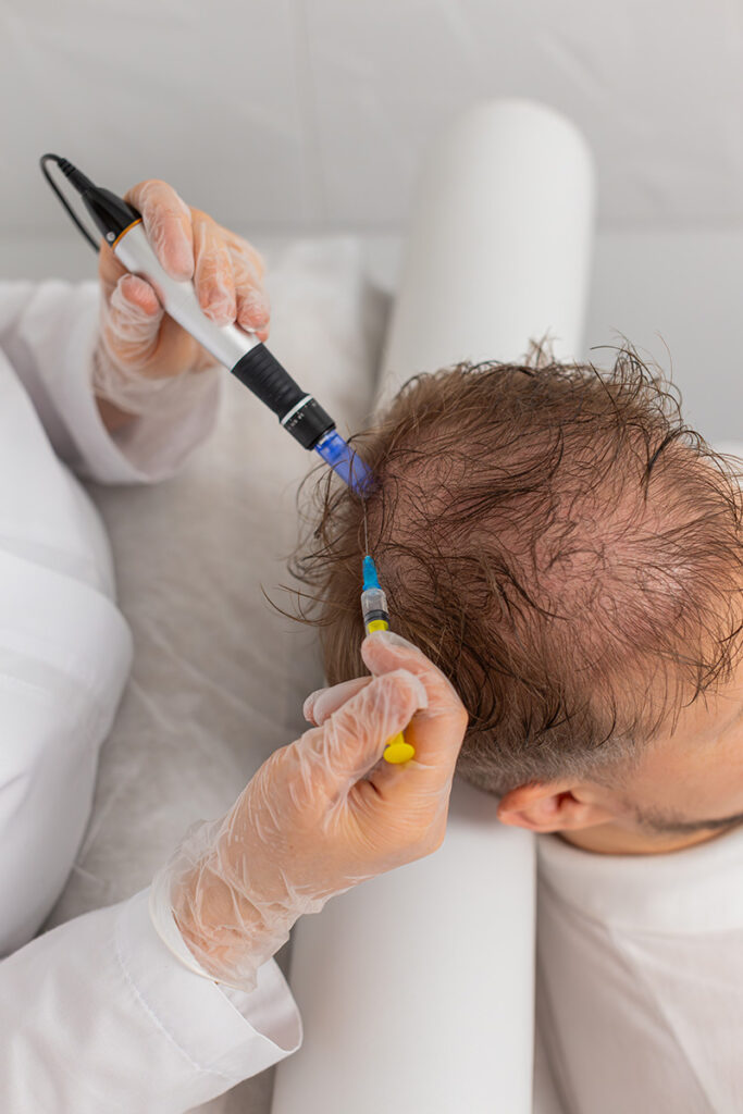 From the Clinic to the Podium: Microneedling as a Regenerative Tool in ...